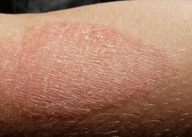 Eczema I The Woodruff Institute for Dermatology